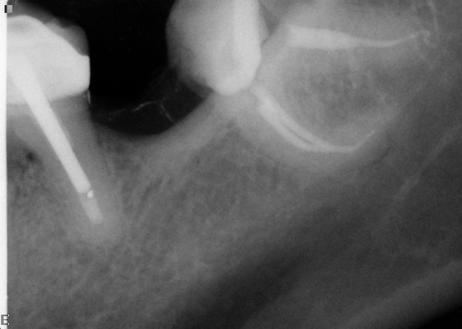 Interesting Cases, Endodontics, Alpharetta GA